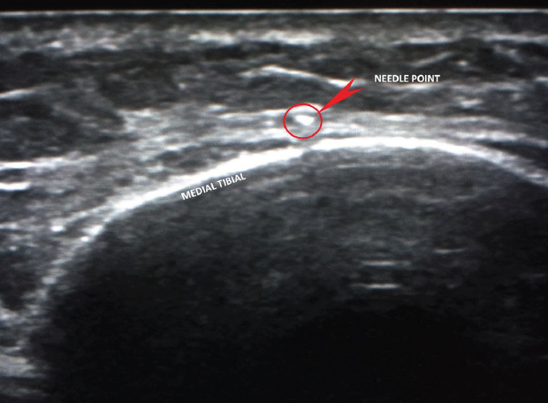 脛前痛 (Shin Splint, Medial Tibial Stress Syndrome) - JIMMY 醫師部落格